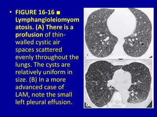 16 High Resolution Computed Tomography of Interstitial and Occupational ...