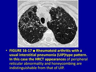 16 High Resolution Computed Tomography of Interstitial and Occupational ...