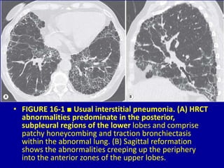 16 High Resolution Computed Tomography of Interstitial and Occupational ...