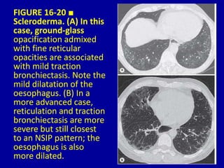 16 High Resolution Computed Tomography of Interstitial and Occupational ...