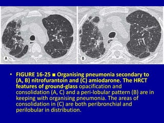 16 High Resolution Computed Tomography of Interstitial and Occupational ...