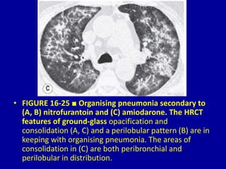 16 High Resolution Computed Tomography of Interstitial and Occupational ...