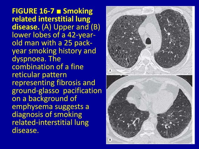 16 High Resolution Computed Tomography of Interstitial and Occupational Lung Diseases | PPT