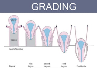 Vaginal Prolapse Grading
