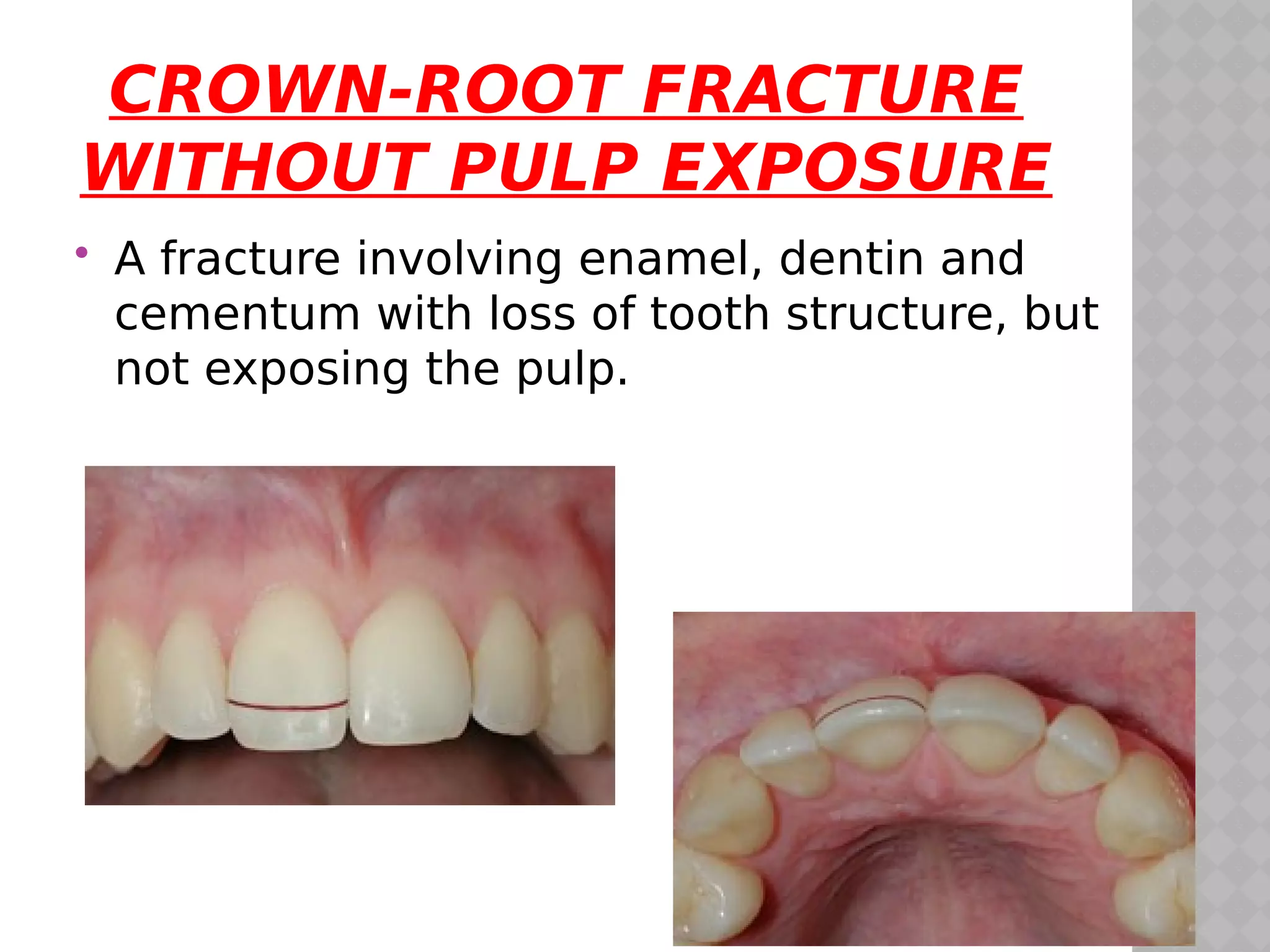 traumatic injuries to teeth | PDF