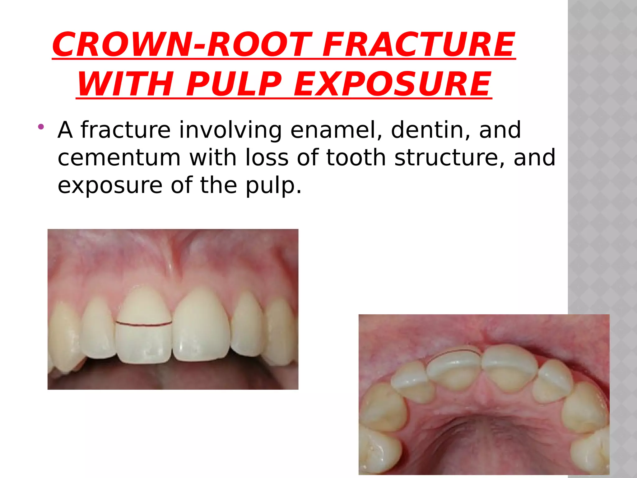 traumatic injuries to teeth | PDF
