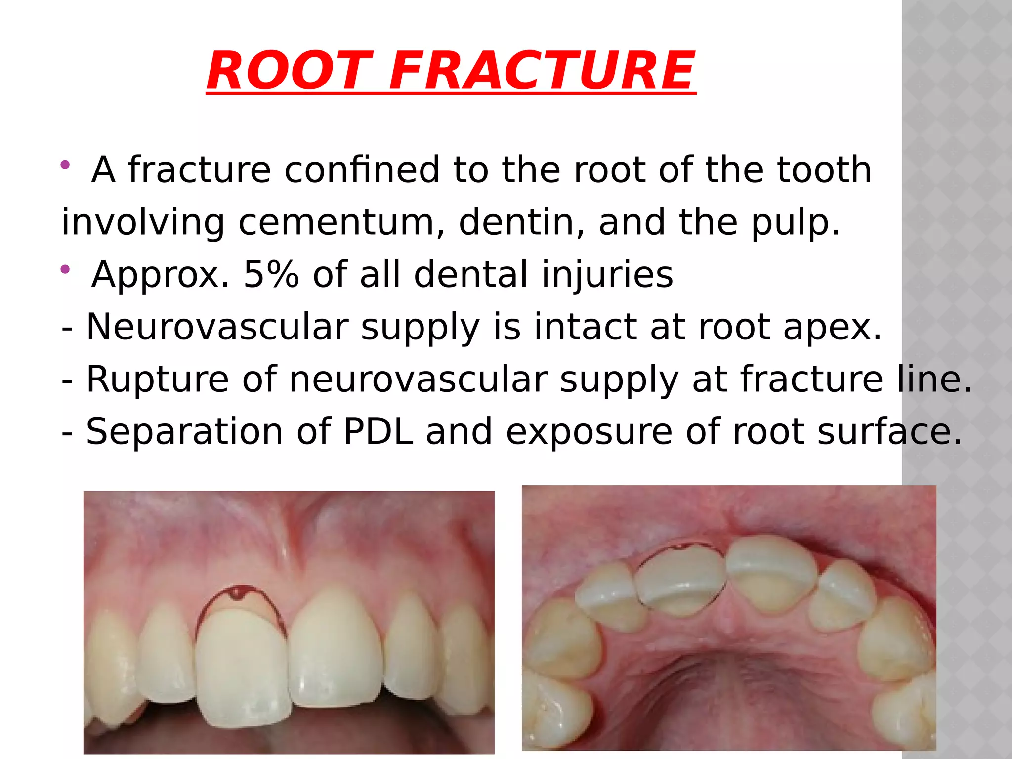 traumatic injuries to teeth | PDF