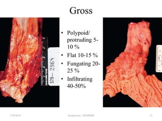 16. symposium adenocarcinoma esophagus | PPT