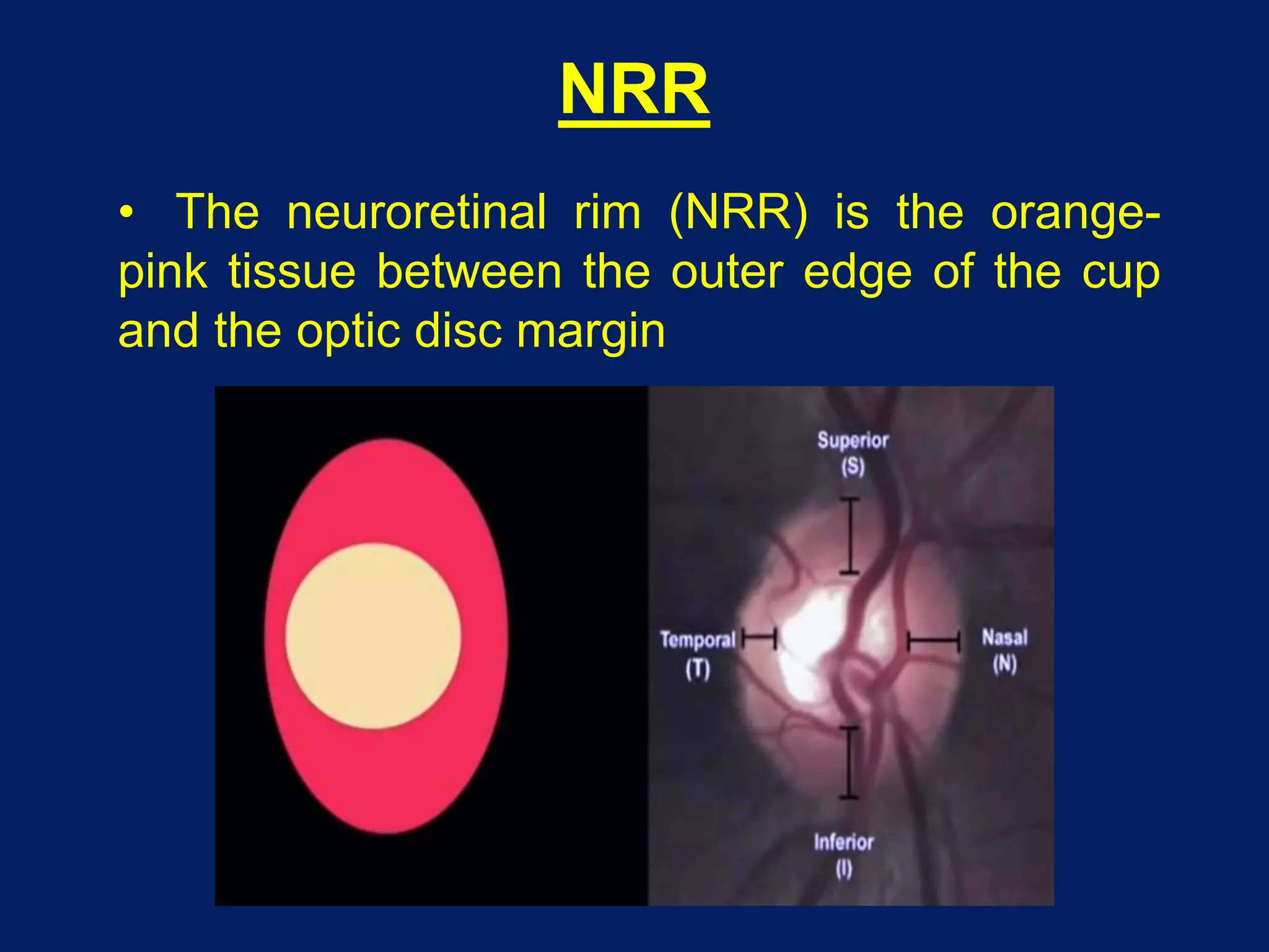 Clinical evaluation of optic disc changes | PPT