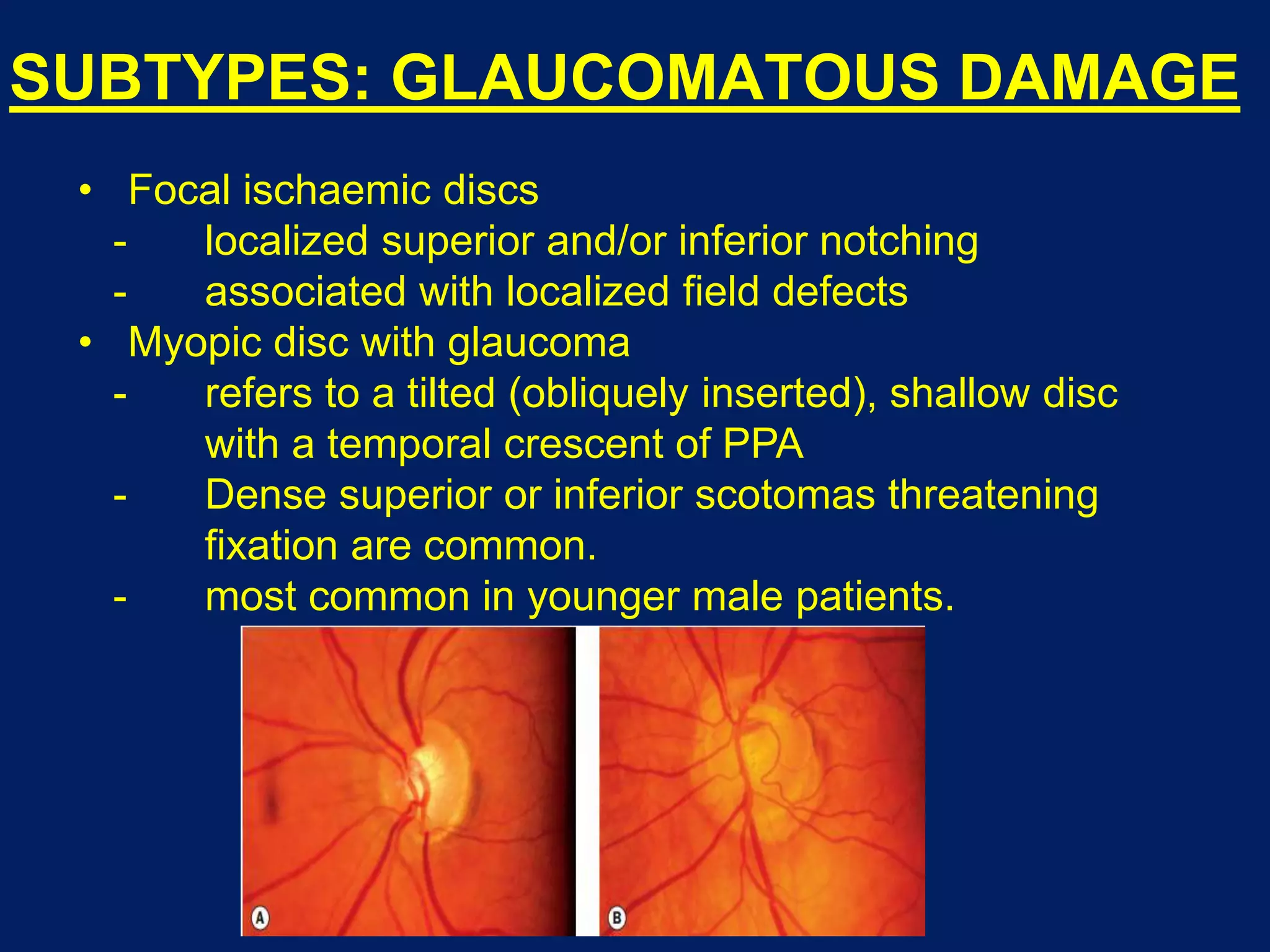 Clinical evaluation of optic disc changes | PPT