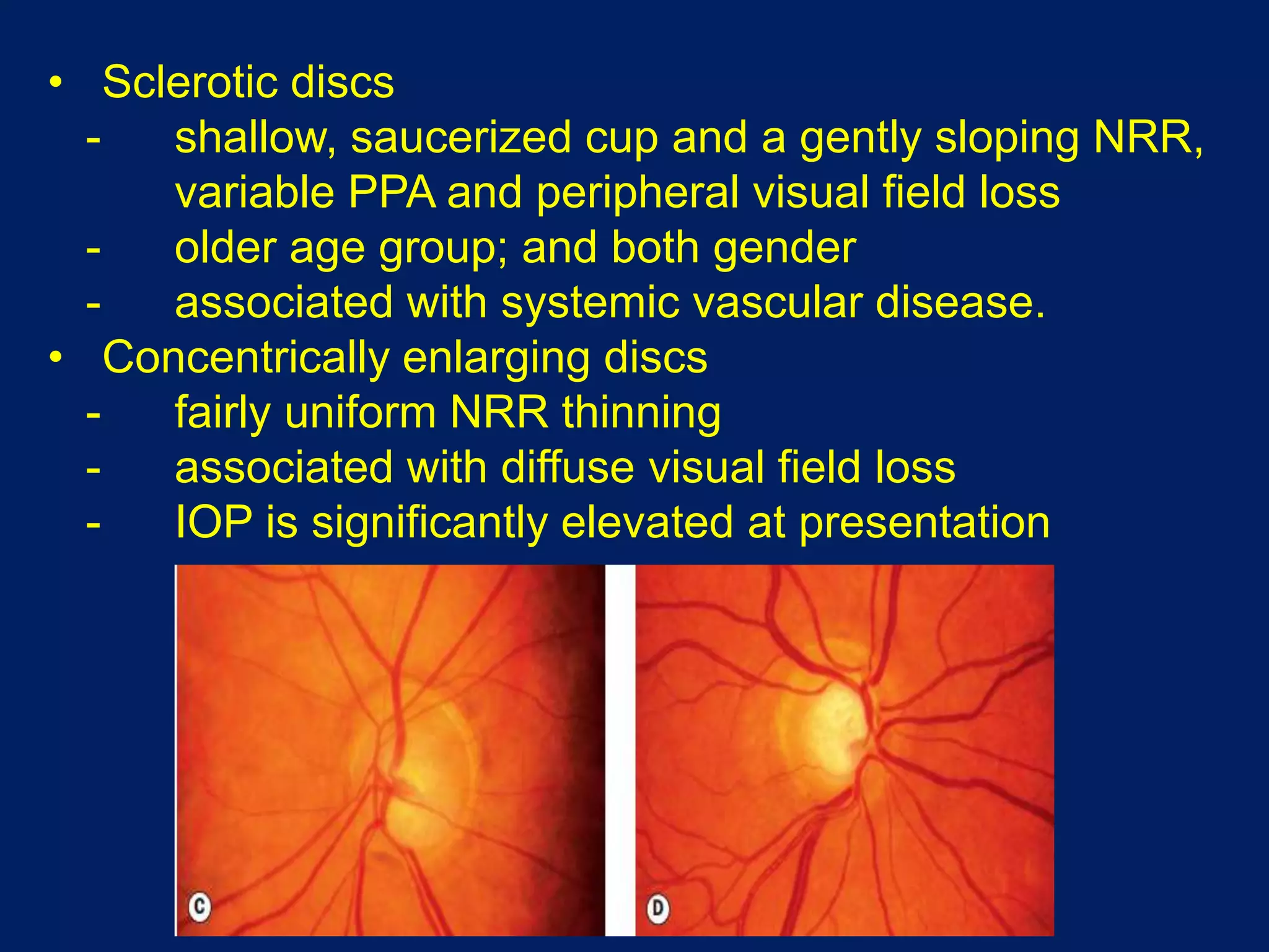 Clinical evaluation of optic disc changes | PPT
