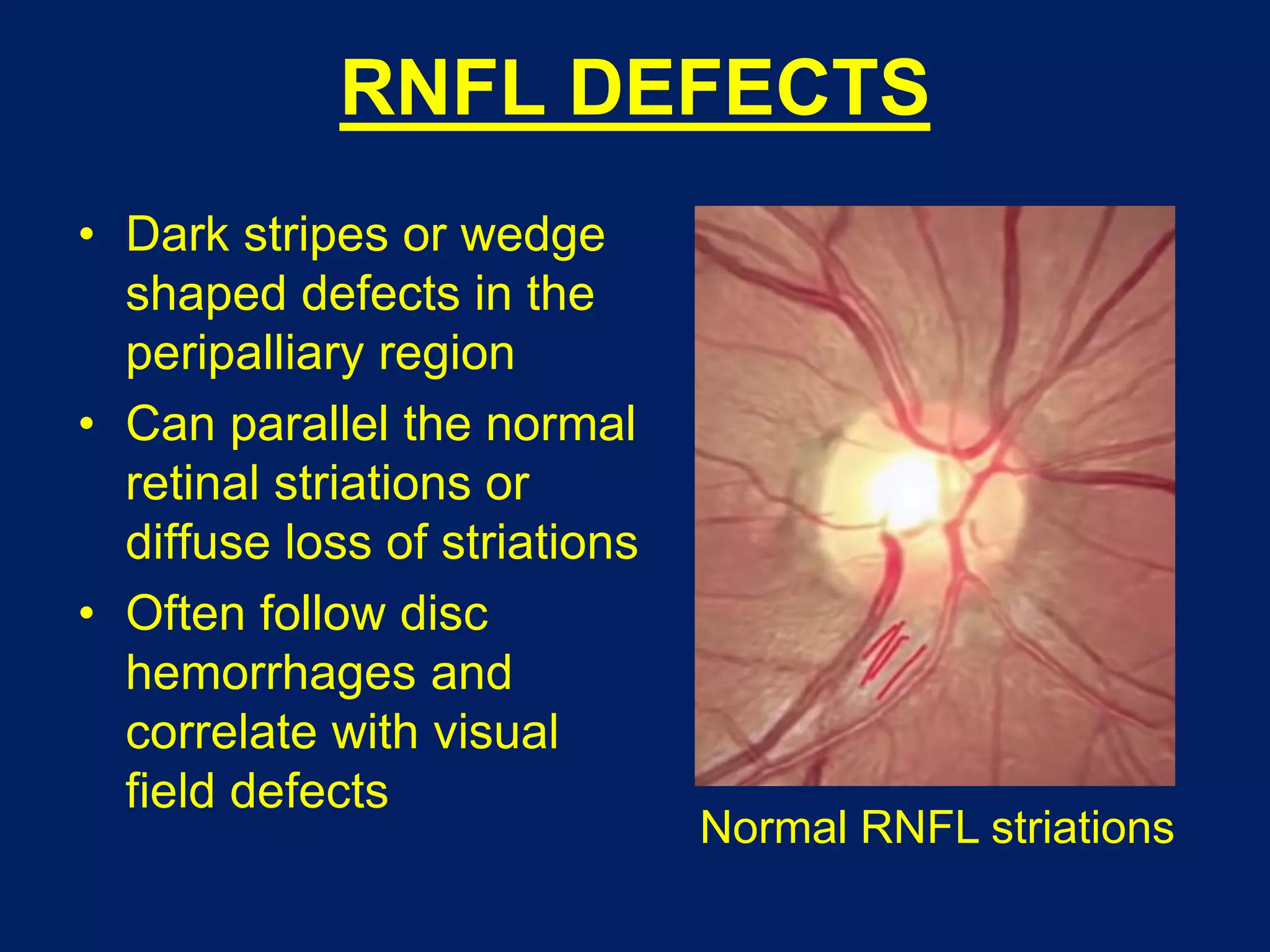Clinical evaluation of optic disc changes | PPT