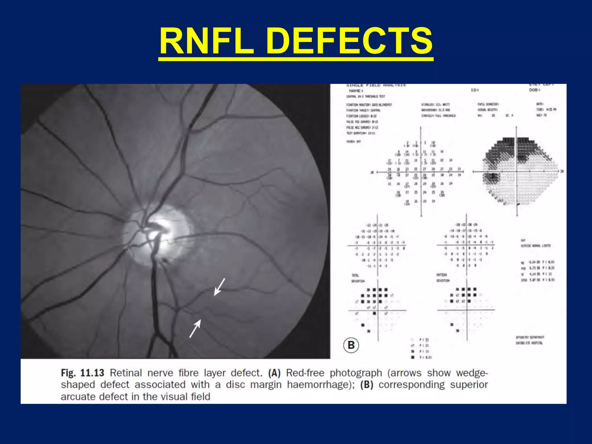 Clinical evaluation of optic disc changes | PPT