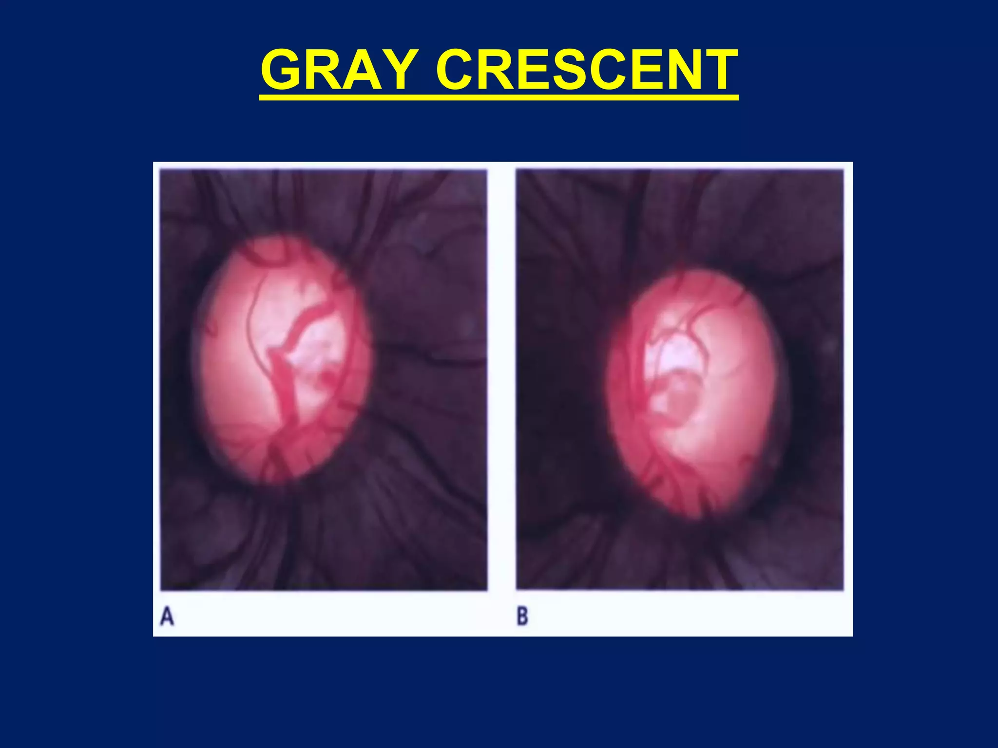 Clinical evaluation of optic disc changes | PPT