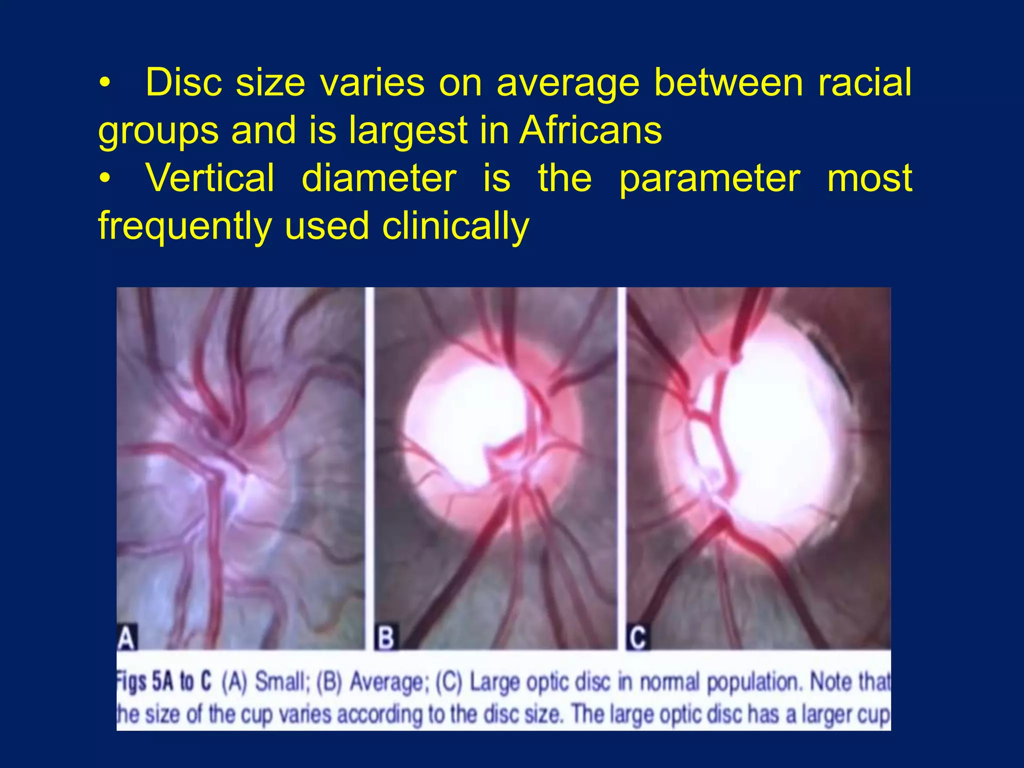 Clinical evaluation of optic disc changes | PPT