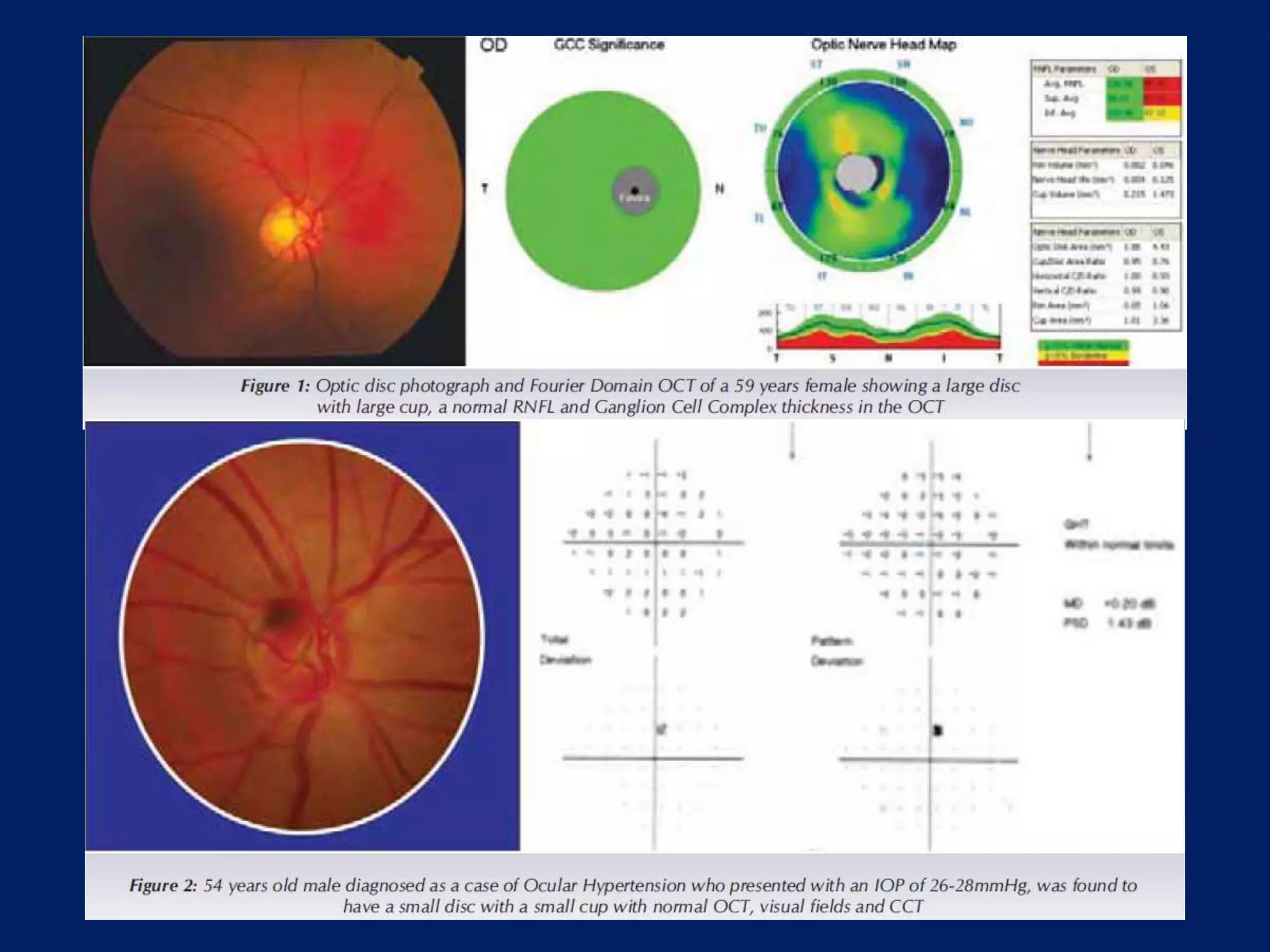 Clinical evaluation of optic disc changes | PPT