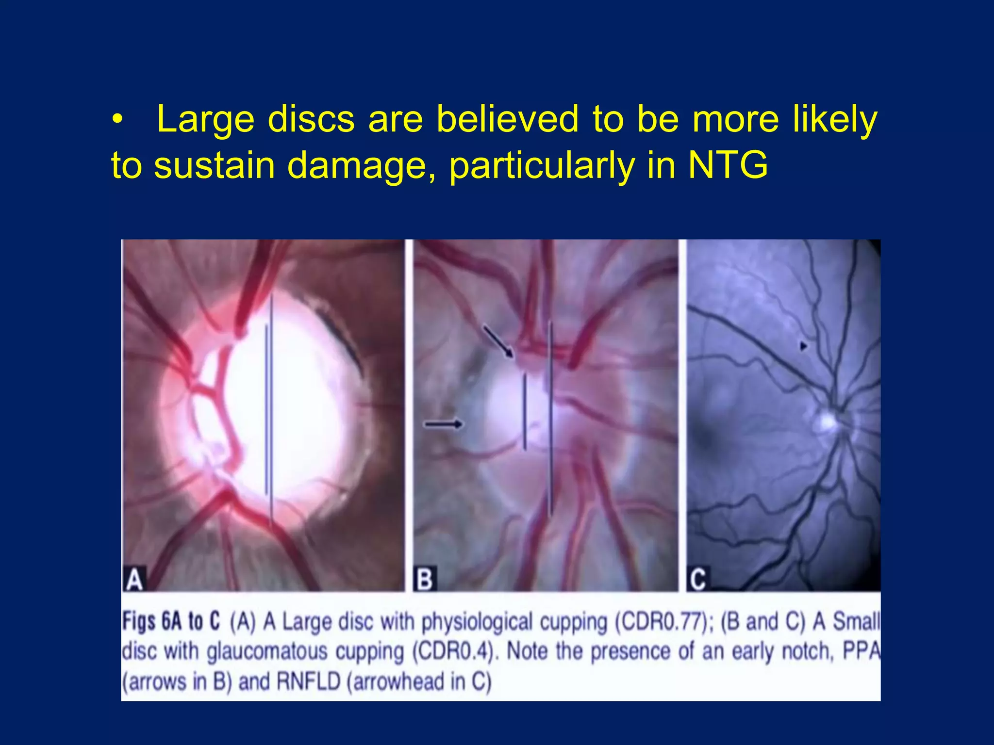 Clinical evaluation of optic disc changes | PPT