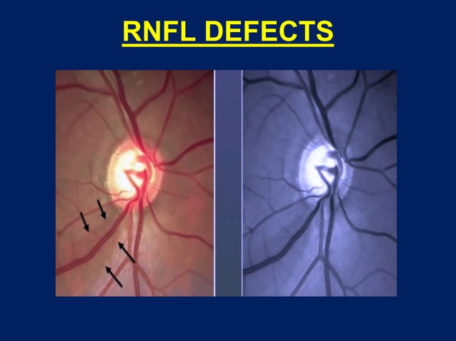Clinical evaluation of optic disc changes | PPT