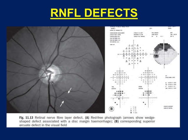 Clinical evaluation of optic disc changes | PPT