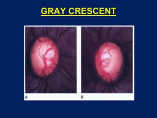 Peripapillary Crescent