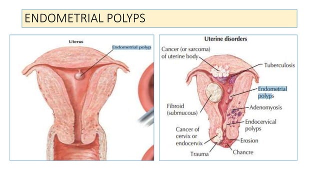 16. Endometrial Polyps.pptx