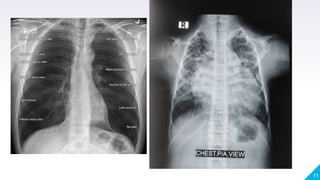 A Case of MVP disgnosed as EDS | PPT
