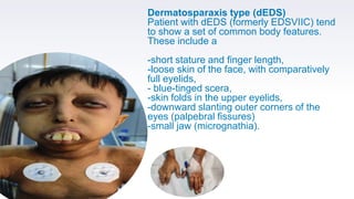 A Case of MVP disgnosed as EDS | PPT