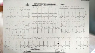 A Case of MVP disgnosed as EDS | PPT