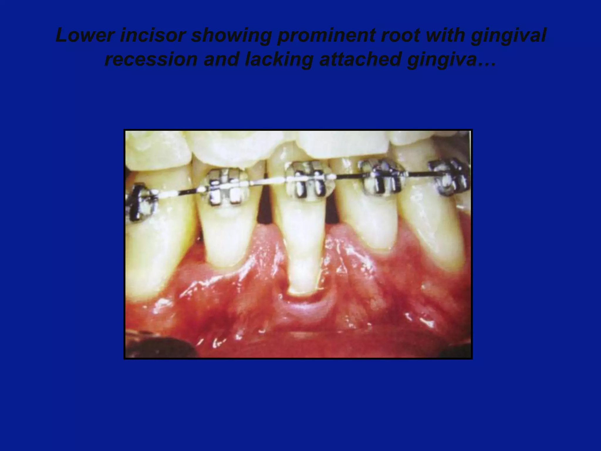 16.Role of dental calculus.ppt