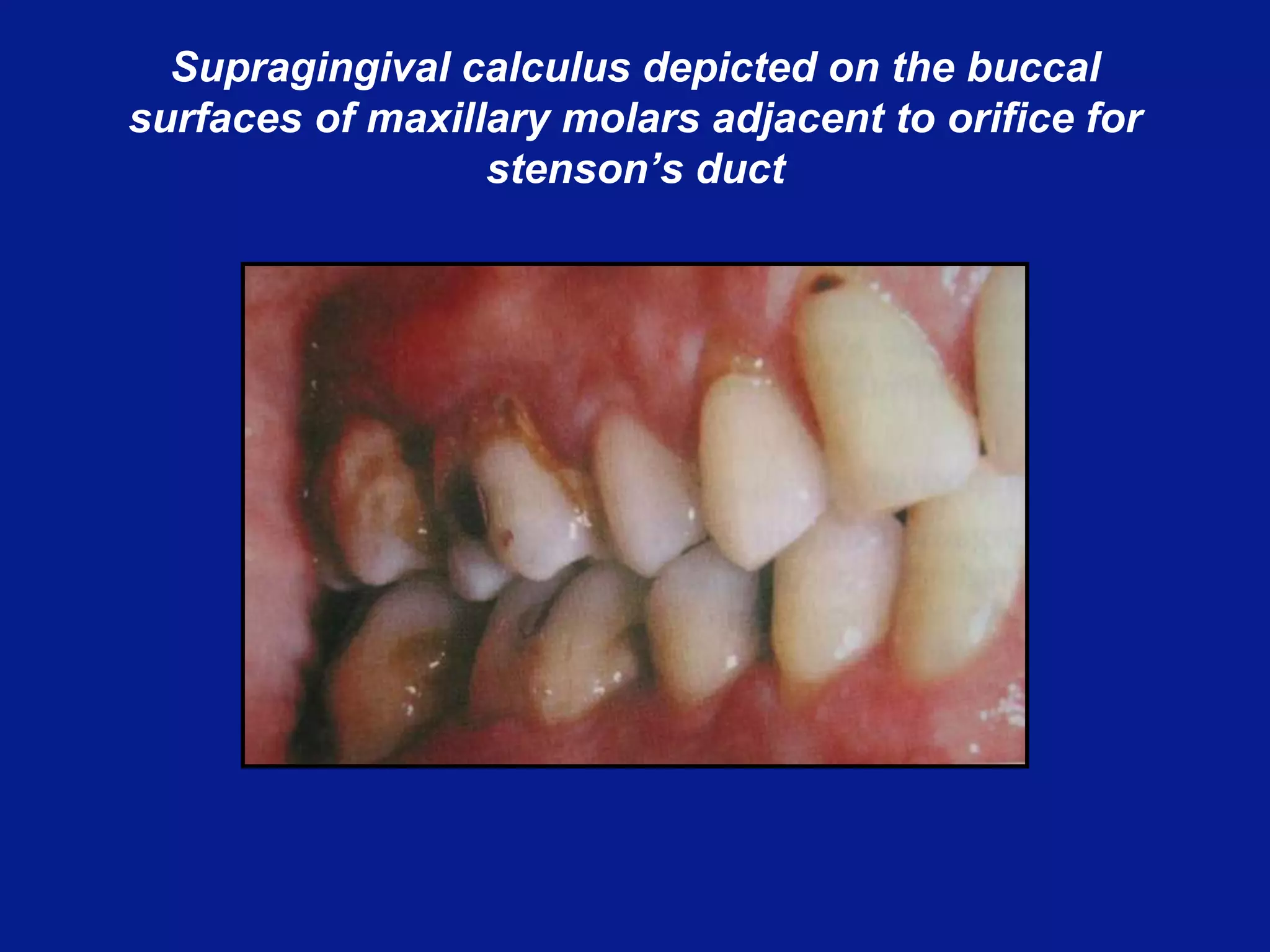 16.Role of dental calculus.ppt