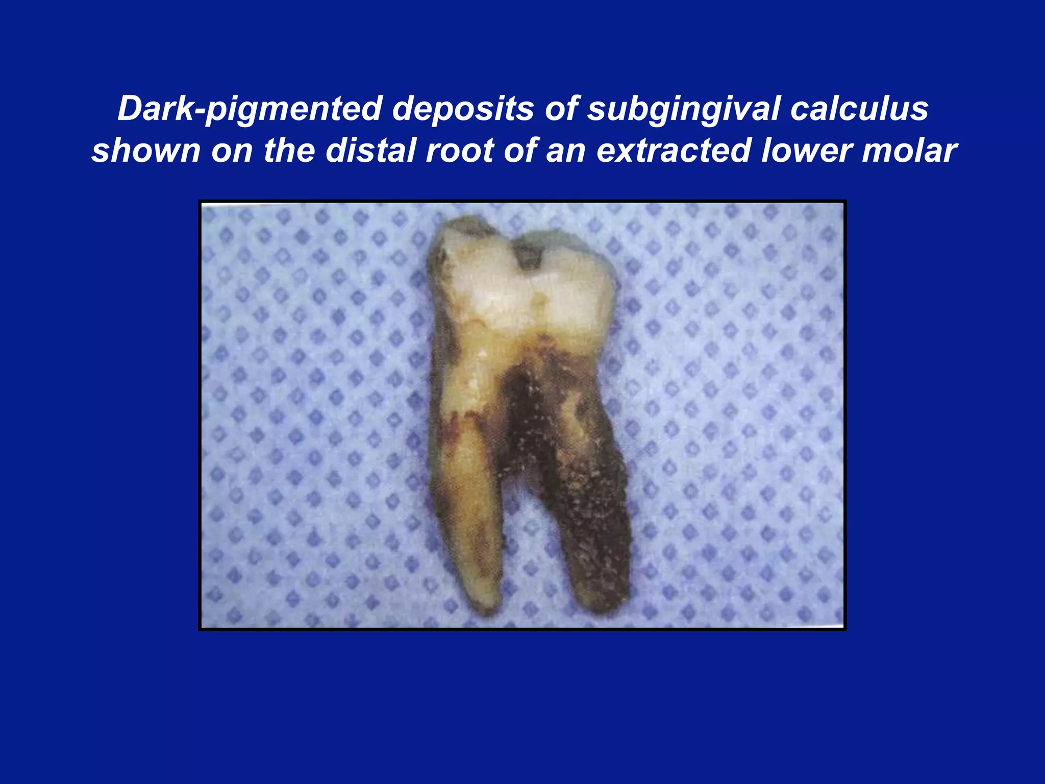 16.Role of dental calculus.ppt