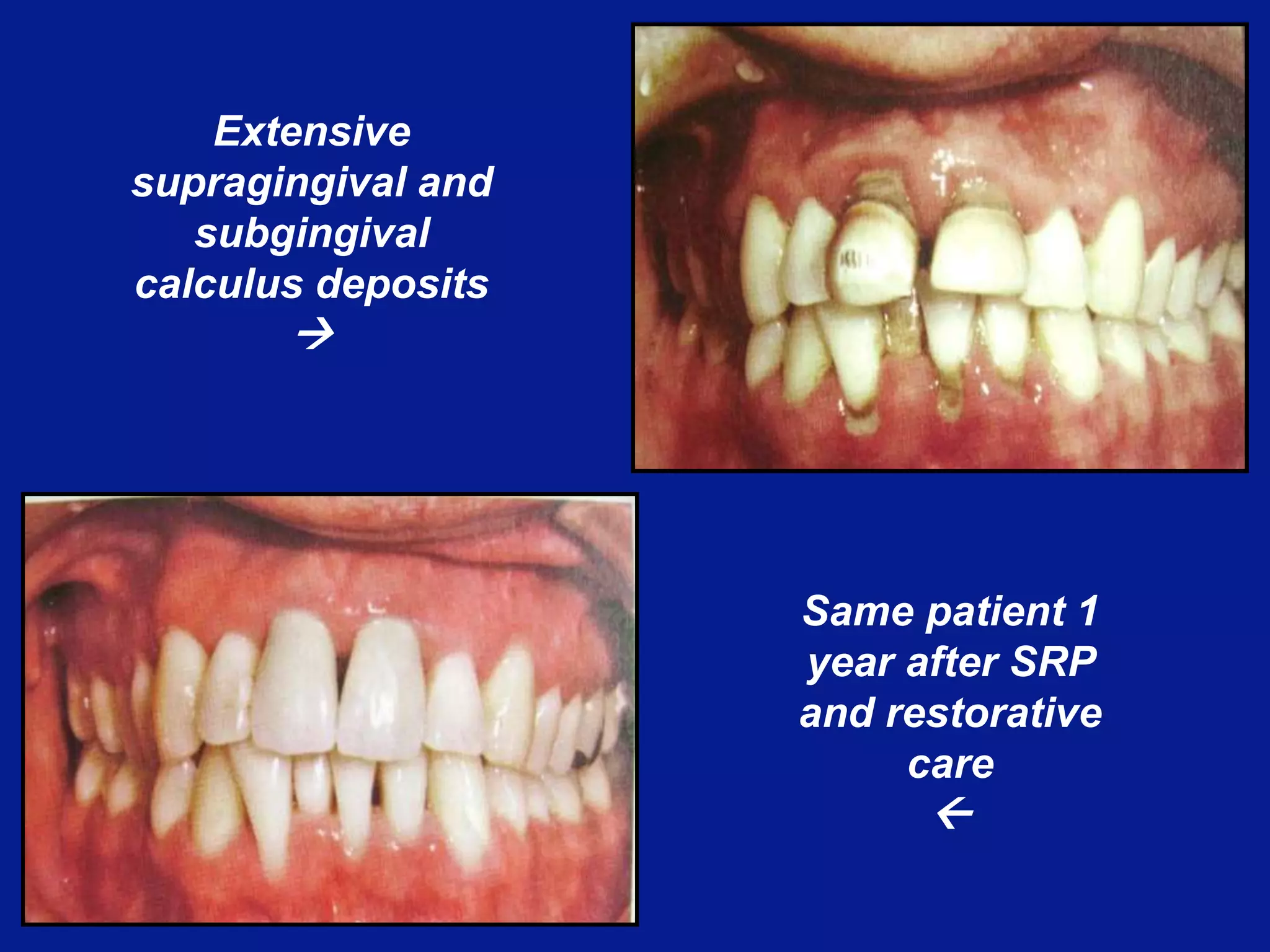16.Role of dental calculus.ppt
