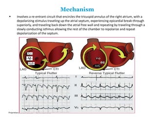16. Atrial Flutter.pptx