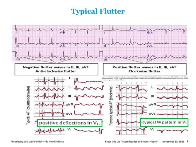 16. Atrial Flutter.pptx