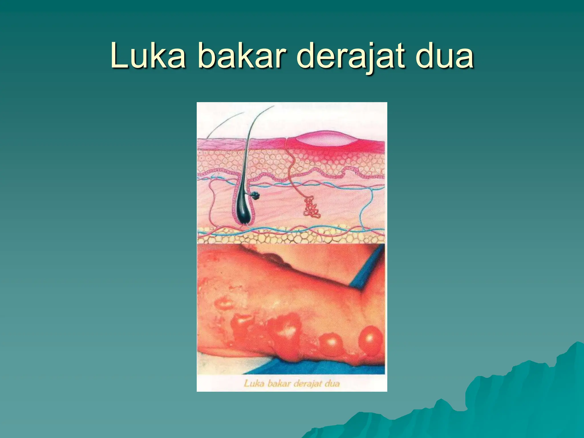 16. LUKA BAKAR.ppt