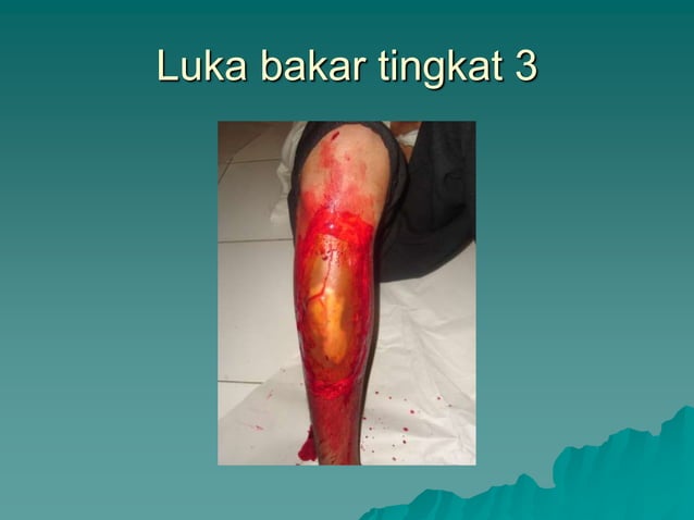 16. LUKA BAKAR.ppt