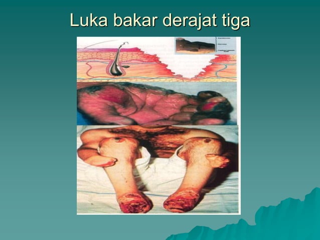 16. LUKA BAKAR.ppt
