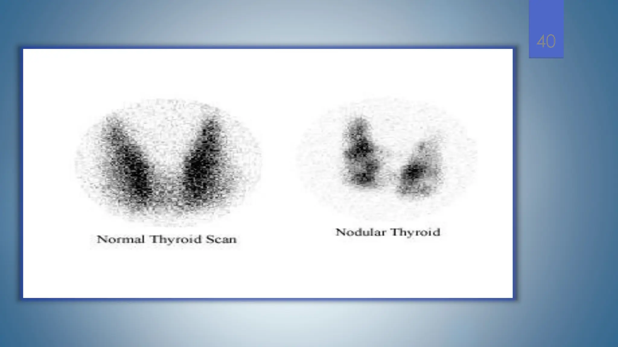 16 Carcinoma Thyroid Powerpoint Presentation Ppt