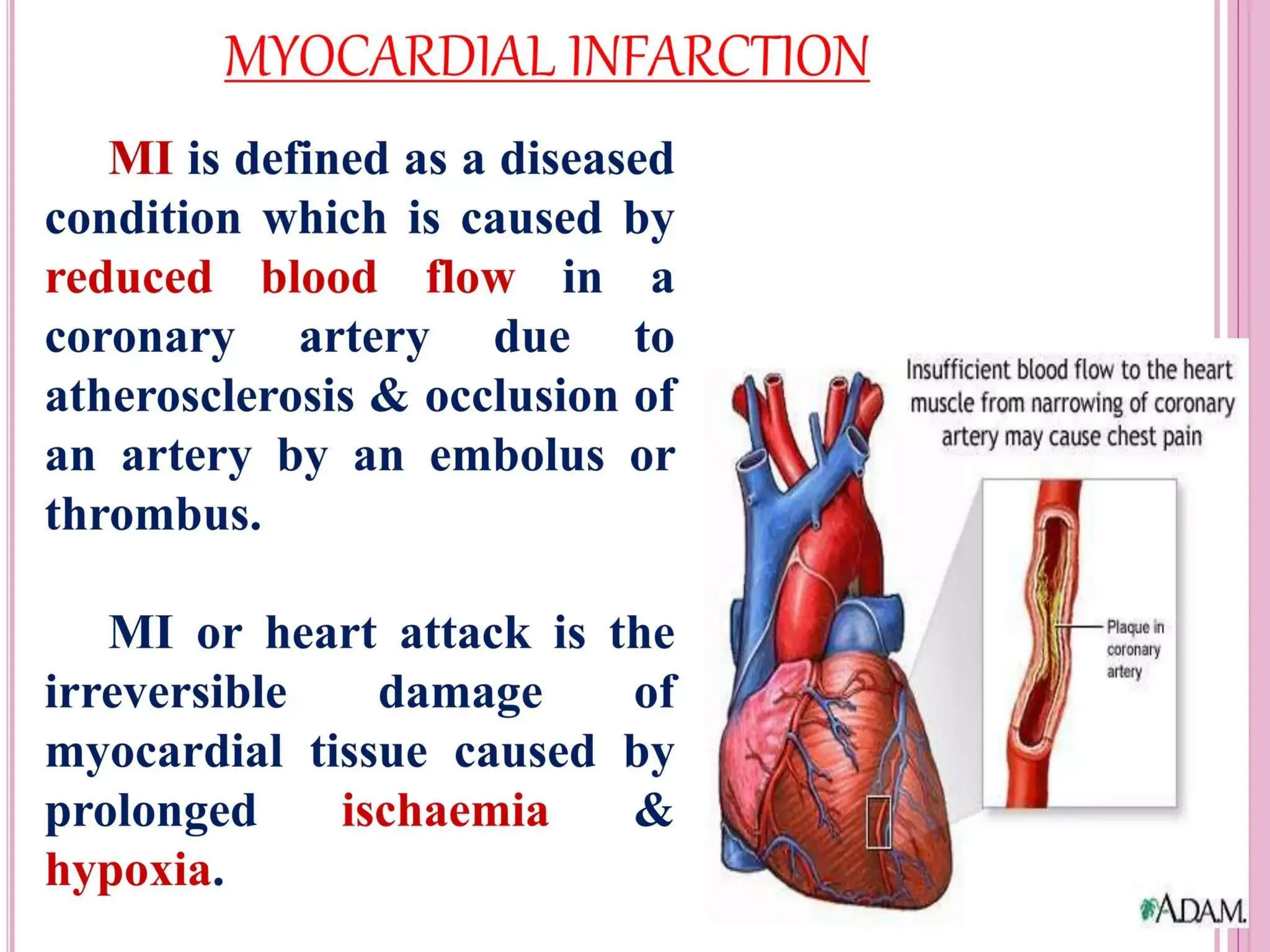 Myocardial infarction, ethiology, pathogenesis | PPTX