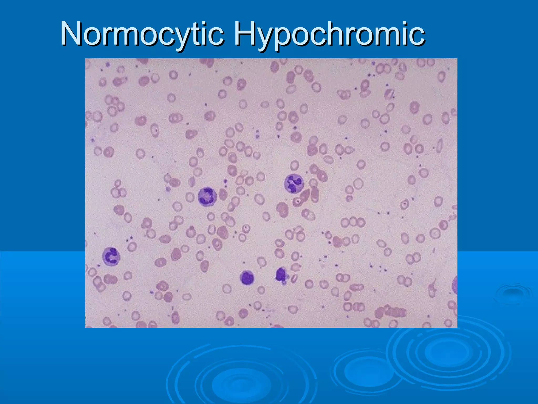16 anemia-laboratory diagnosis | PPT