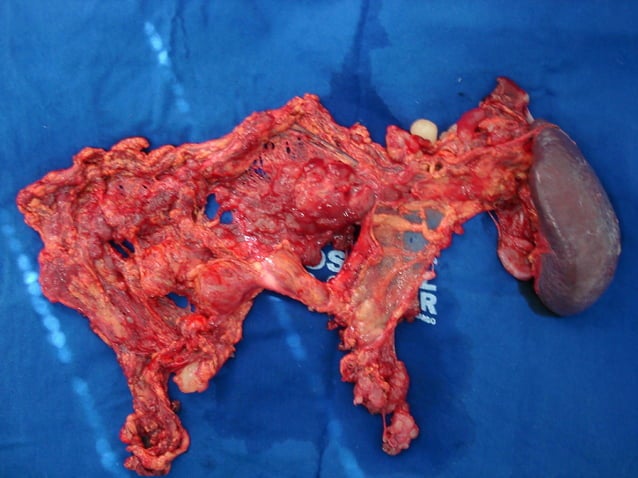 16 cirurgia citorredutora e quimioterapia intraperitoneal hipertérmica ...