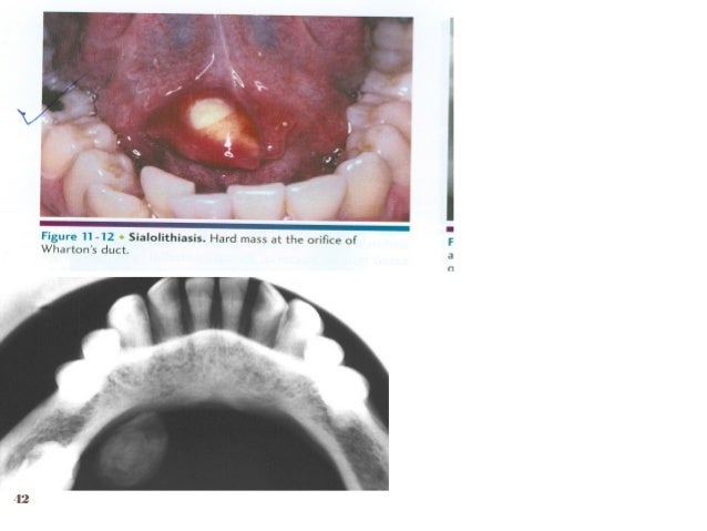 16 Diseases Of Salivary Glands