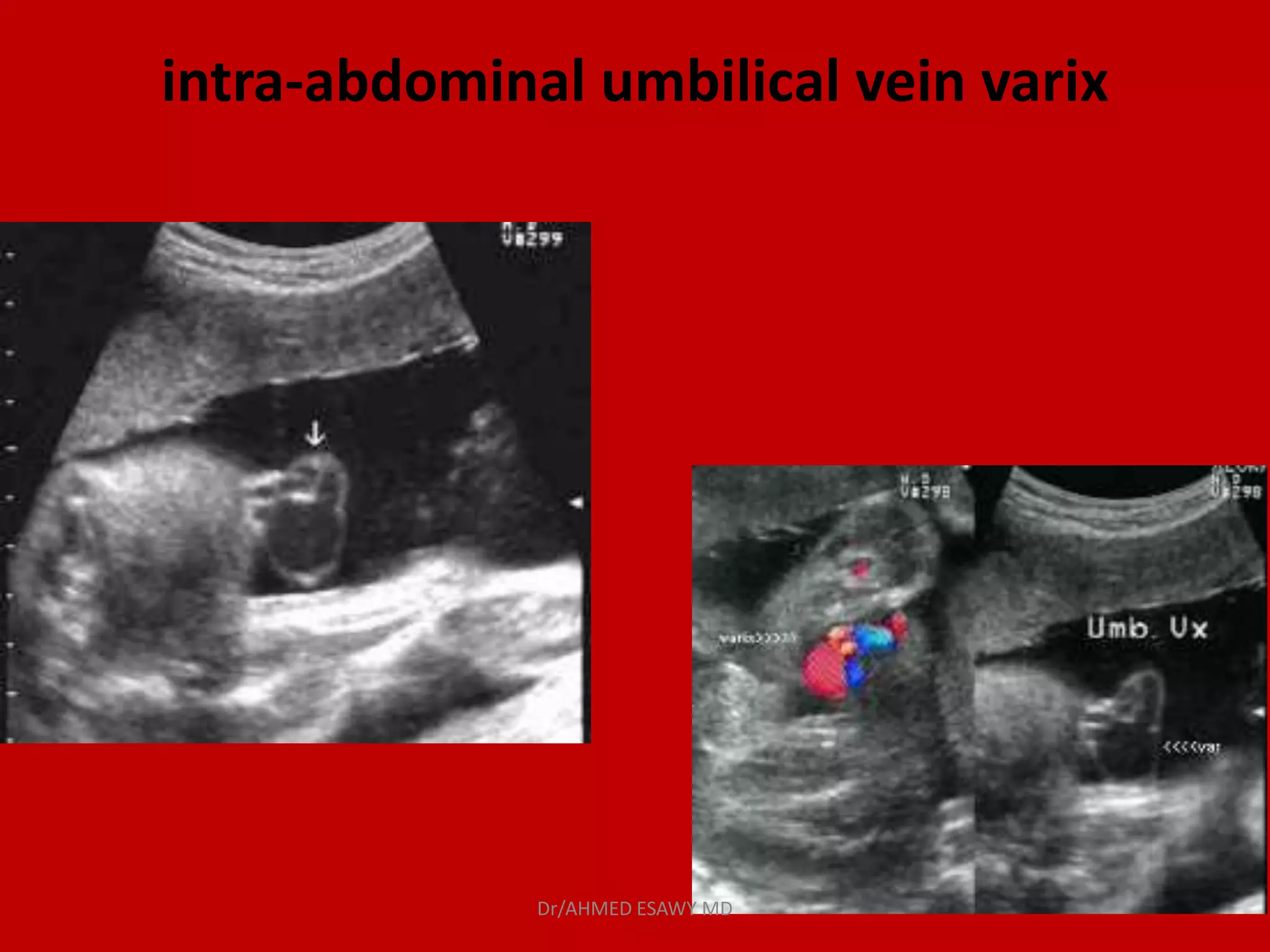 16-fetal vascular malformations imaging Dr Ahmed Esawy | PDF