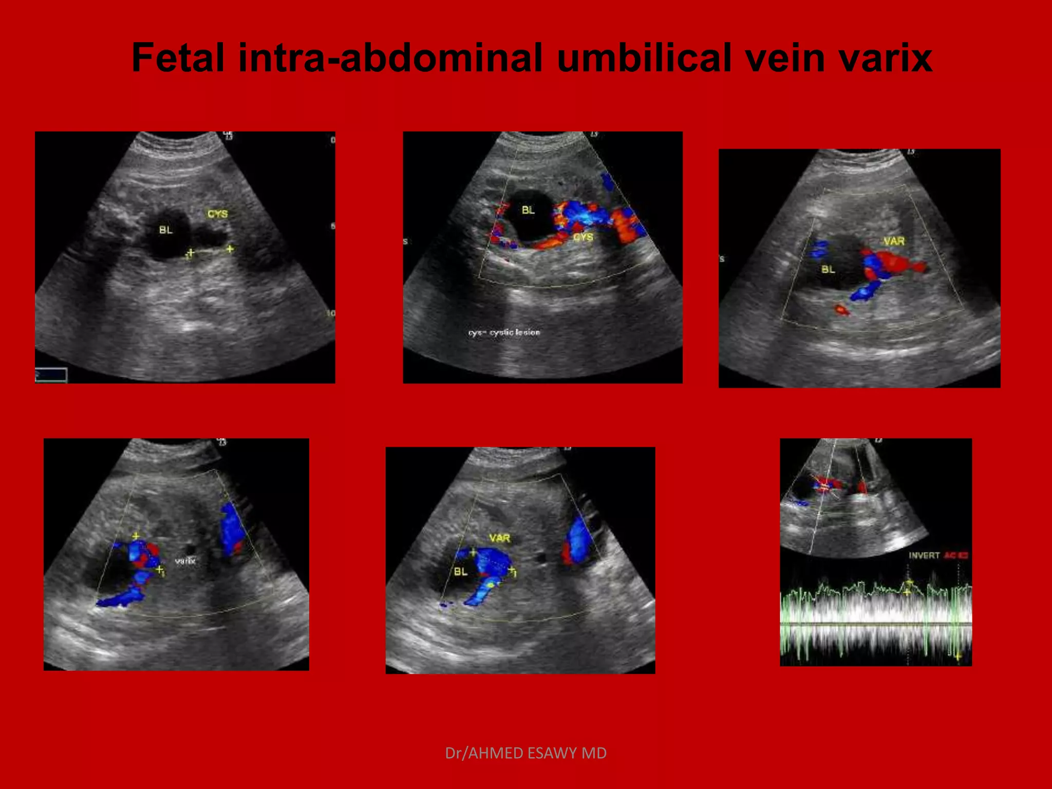 16-fetal vascular malformations imaging Dr Ahmed Esawy | PDF