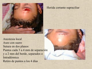 Heridas Pediatria Medica | PPT