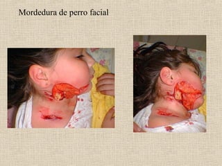 Heridas Pediatria Medica Ppt