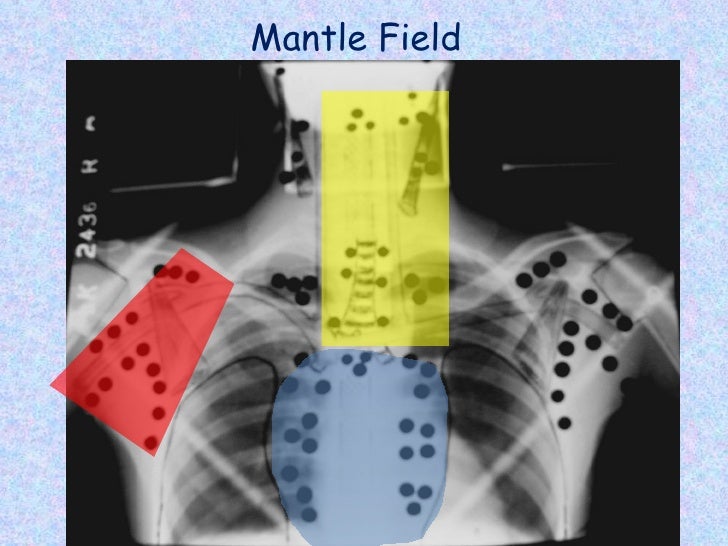 Hodgkin’s Lymphoma