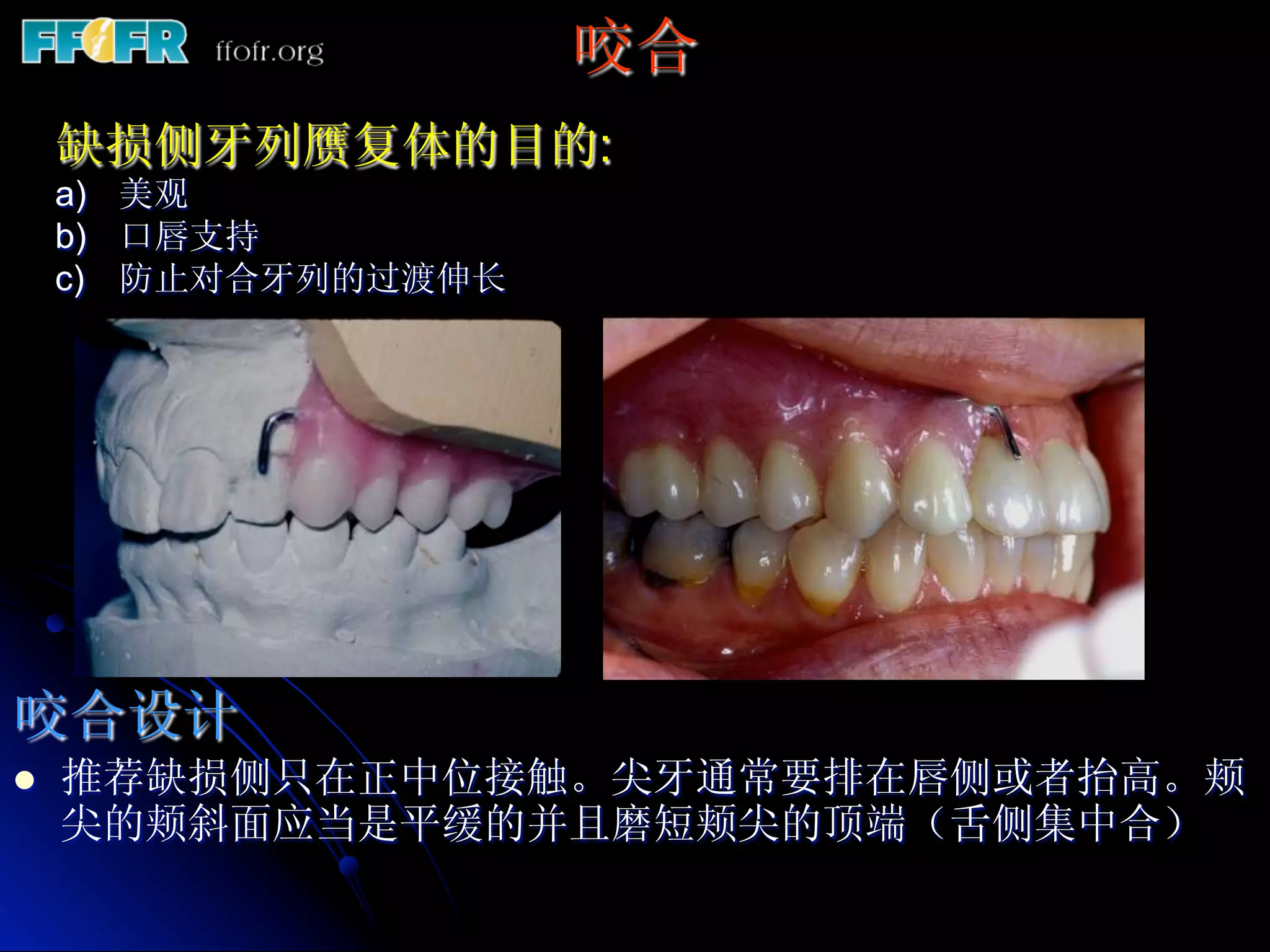 16.mfp defects and rpd design | PPT