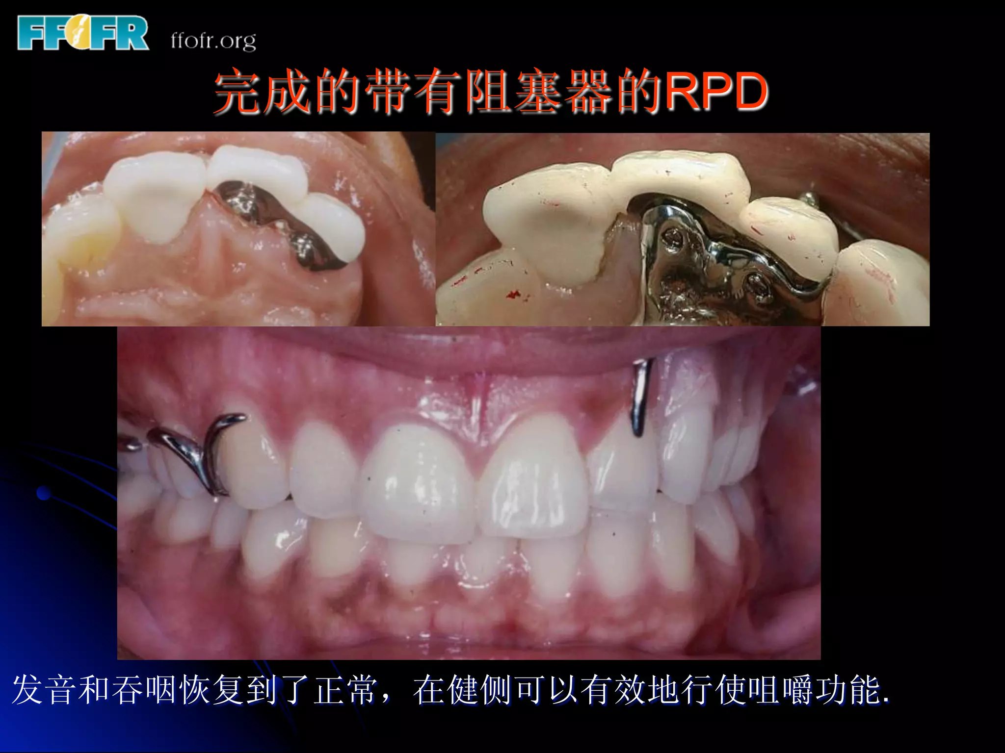 16.mfp defects and rpd design | PPT