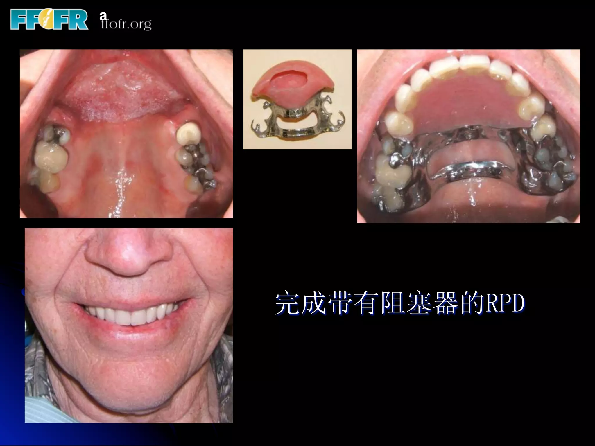 16.mfp defects and rpd design | PPT